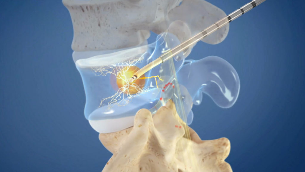 Relieve Pain Center to Offer Breakthrough Treatment for Patients with ...