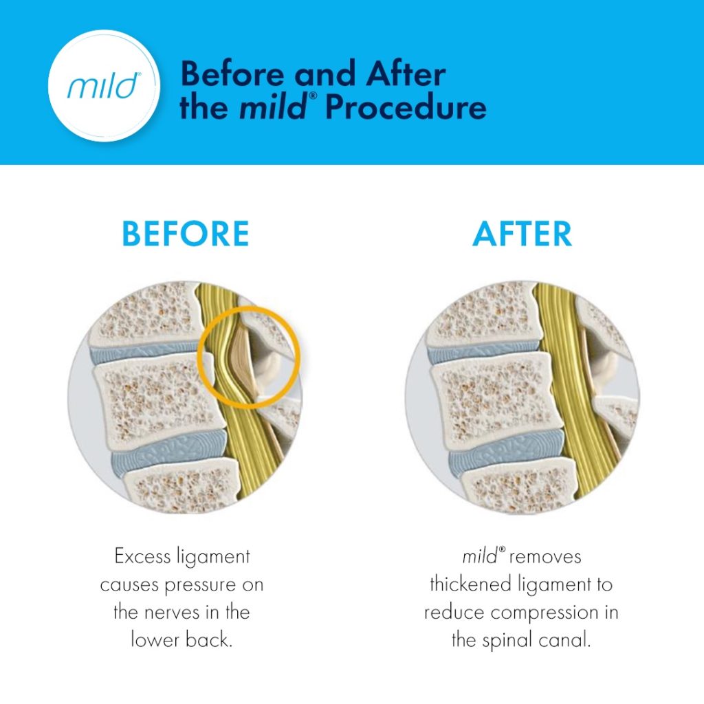 About the mild® Procedure - Relieve Pain Center
