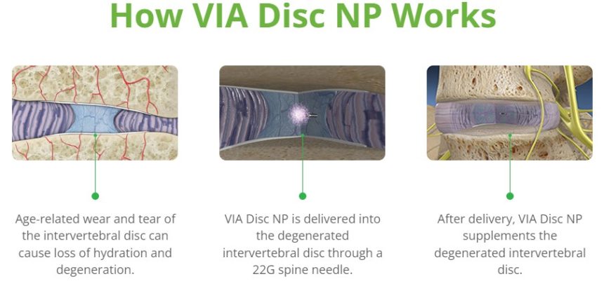 Via Disc NP: A New Non-Surgical Treatment for Lumbar Degenerative Disc ...
