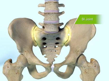 Sacroiliac Joint Arthrodesis - San Diego, CA -Relieve Pain Center